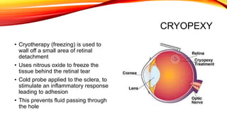 Retinal detachment | PPTX