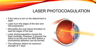 Retinal detachment | PPTX
