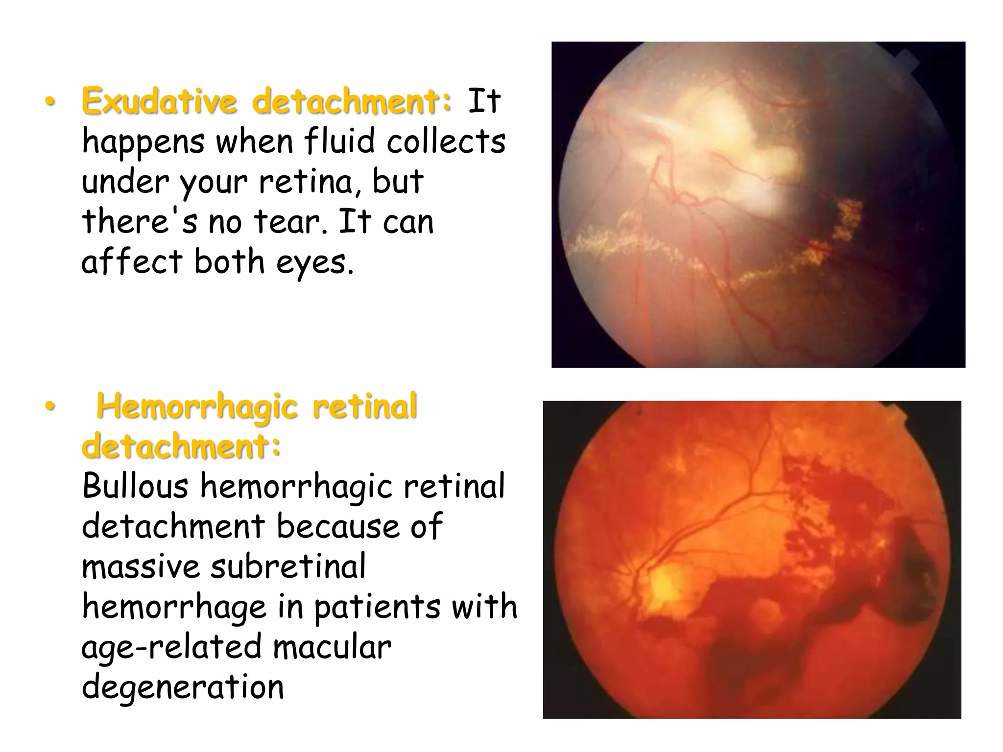 Retinal detachment | PPTX