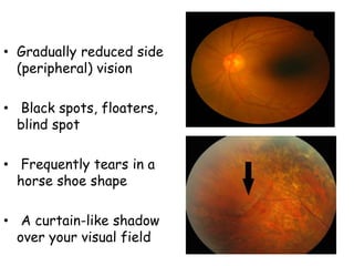 Retinal detachment | PPTX | Eye and Vision Conditions | Diseases and ...