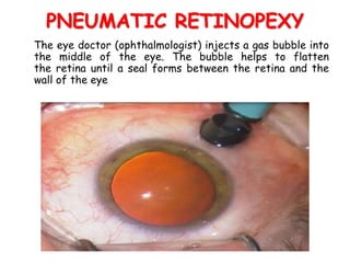 Retinal detachment | PPTX