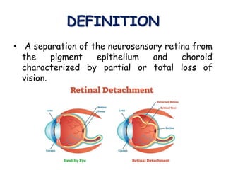 Retinal detachment | PPTX