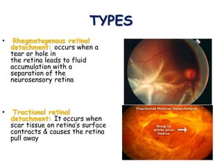 Retinal detachment | PPTX
