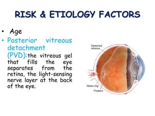 Retinal detachment | PPTX