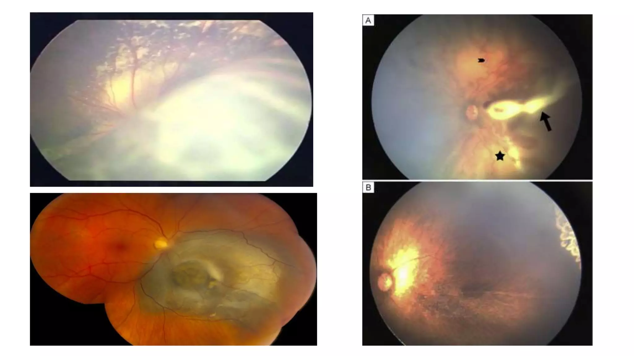 Retinal detachment | PPTX