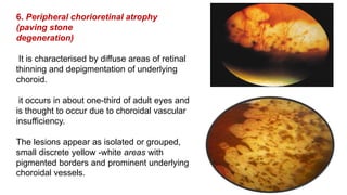 Retinal detachment | PPTX