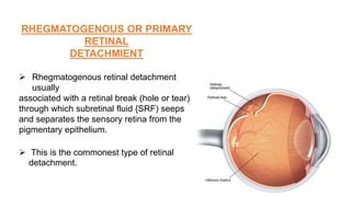 Retinal detachment | PPTX