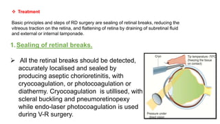 Retinal detachment | PPTX