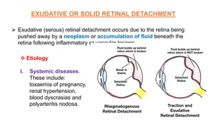 Retinal detachment | PPTX