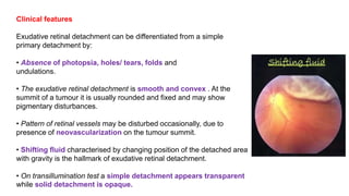 Retinal detachment | PPTX