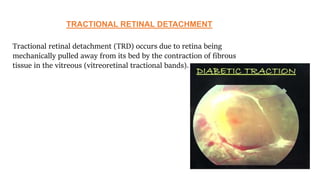 Retinal detachment | PPTX