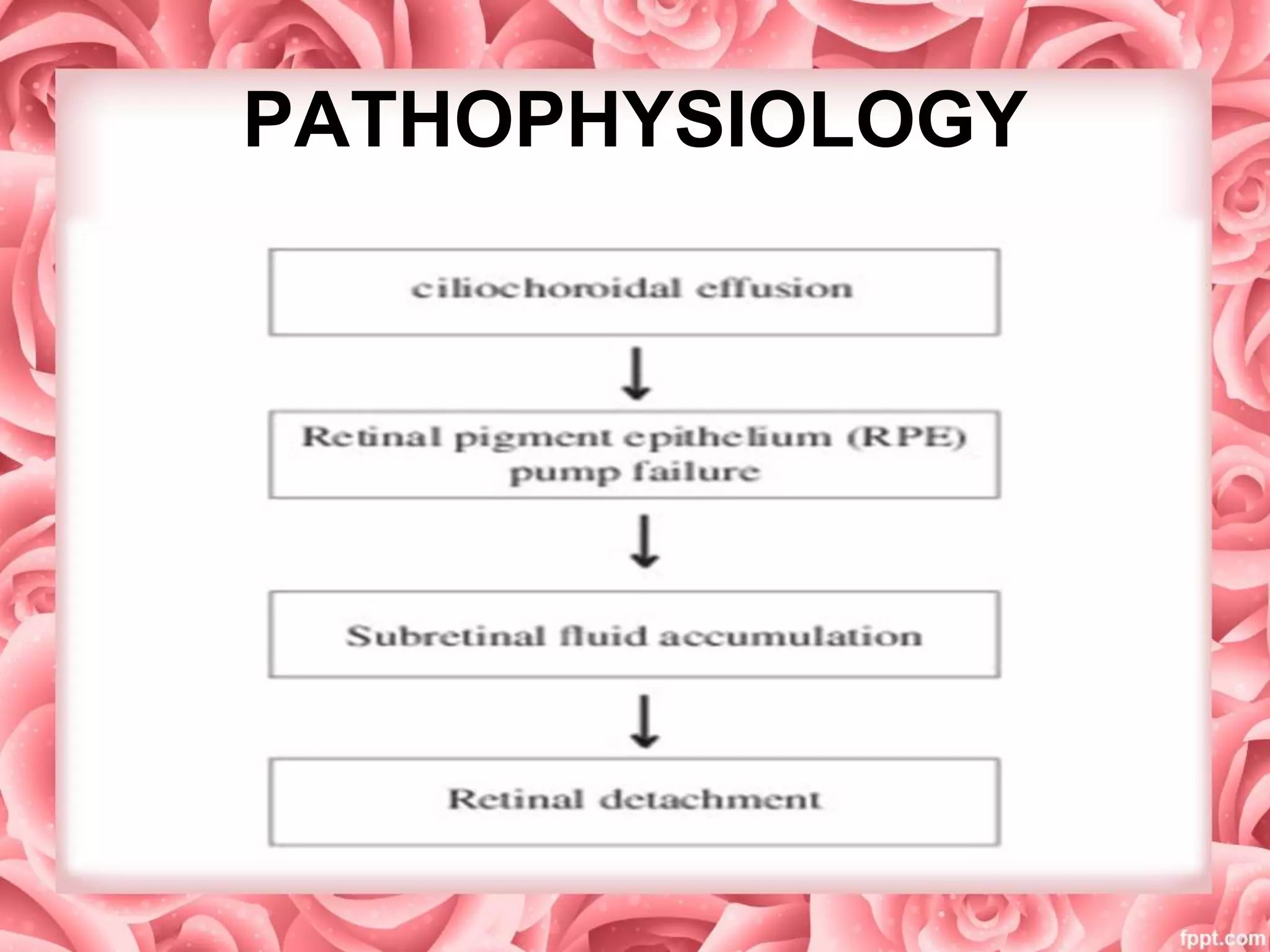 Retinal detachment | PPT