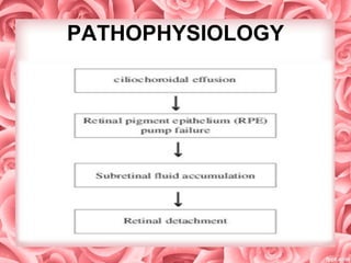 Retinal detachment | PPT