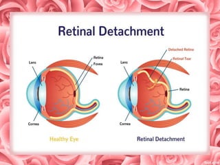 Retinal detachment | PPT