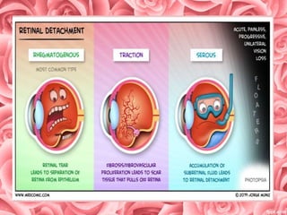 Retinal detachment | PPT