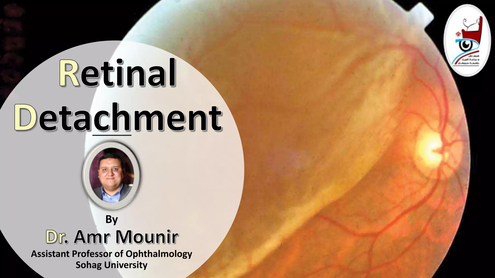 Retinal detachment | PPTX