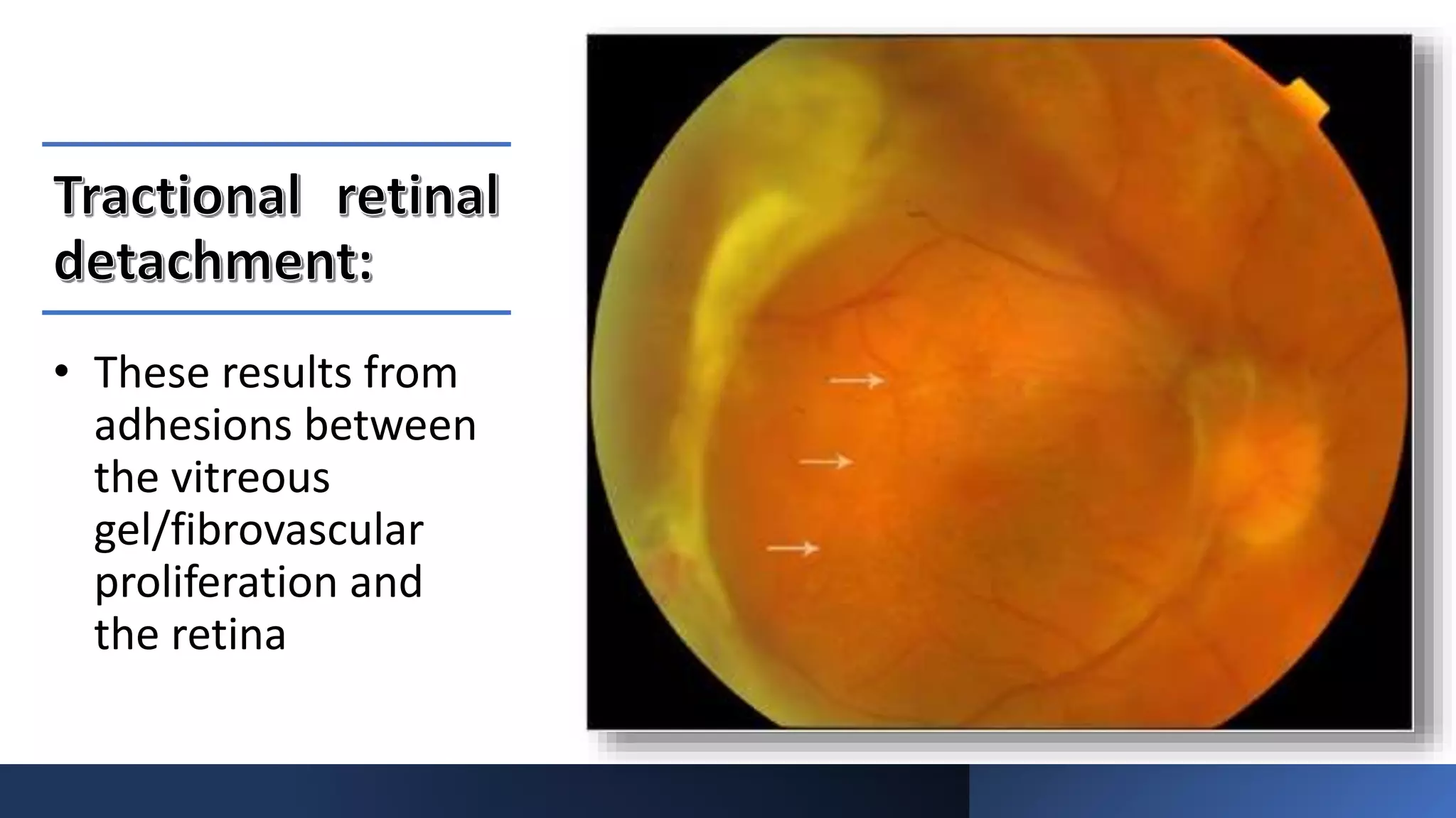 Retinal detachment | PPTX