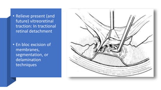 Retinal detachment | PPTX