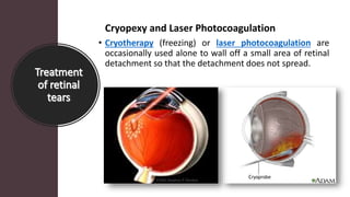 Retinal detachment | PPTX