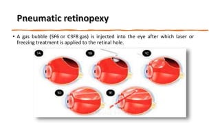 Retinal detachment | PPTX