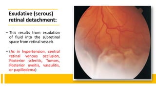 Retinal detachment | PPTX