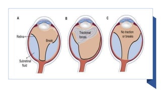 Retinal detachment | PPTX