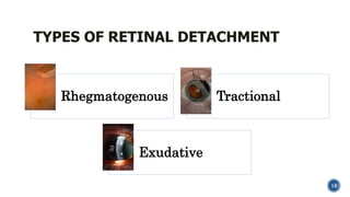retinal detachment.pptx