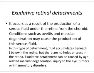 retinal detachment.pdf