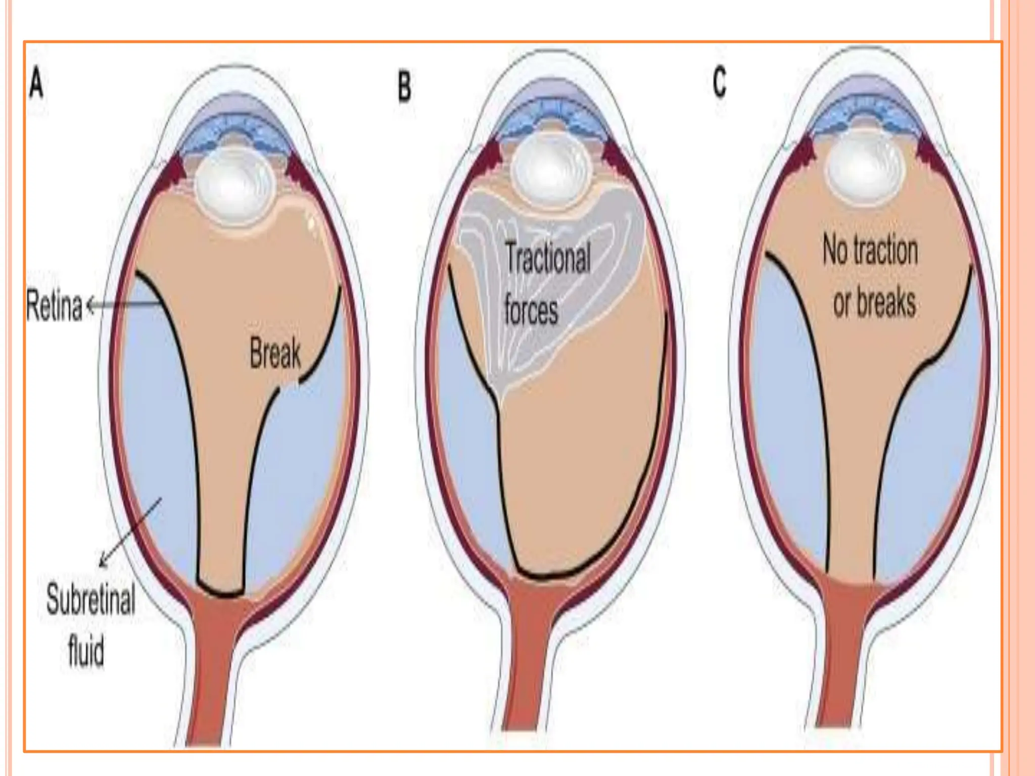 REtinal detachment.pptx