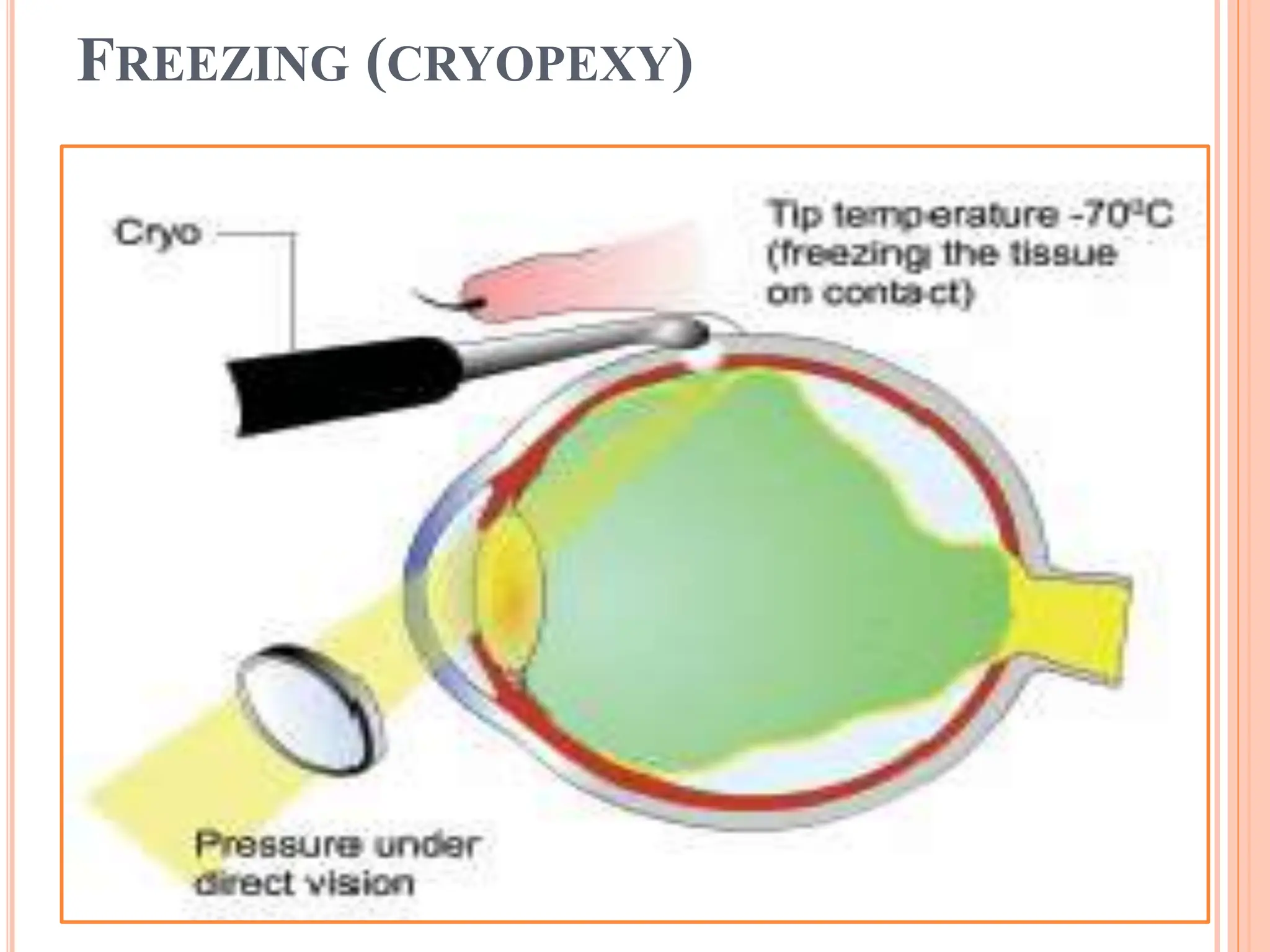 REtinal detachment.pptx