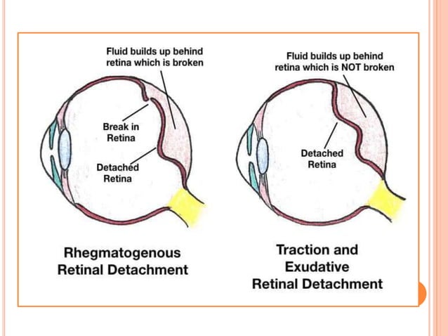 REtinal detachment.pptx