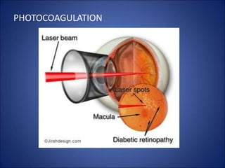 retinal detachment (basics and advanced) | PPTX