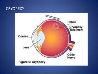 retinal detachment (basics and advanced) | PPTX