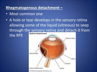 retinal detachment (basics and advanced) | PPTX | Eye and Vision ...