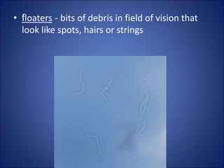 retinal detachment (basics and advanced) | PPTX