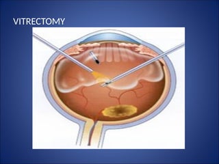 retinaldetachment-231220054928-55e589a5 (1).pptx
