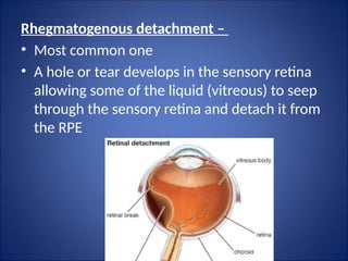 retinaldetachment-231220054928-55e589a5 (1).pptx