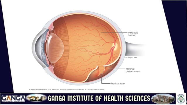 retinal detachment and its management for nursing students | PPTX