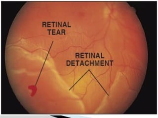 Retinal detachment a brief presentation.pptx