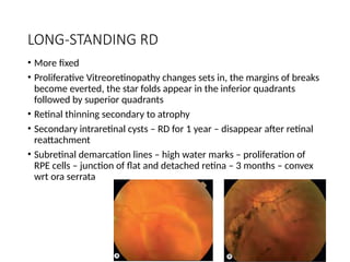 RETINAL DETACHMENT.pptxRetinal detachment is the separation of the ...