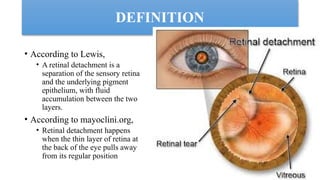 Retinal detachment by Anushri Srivastava.pptx