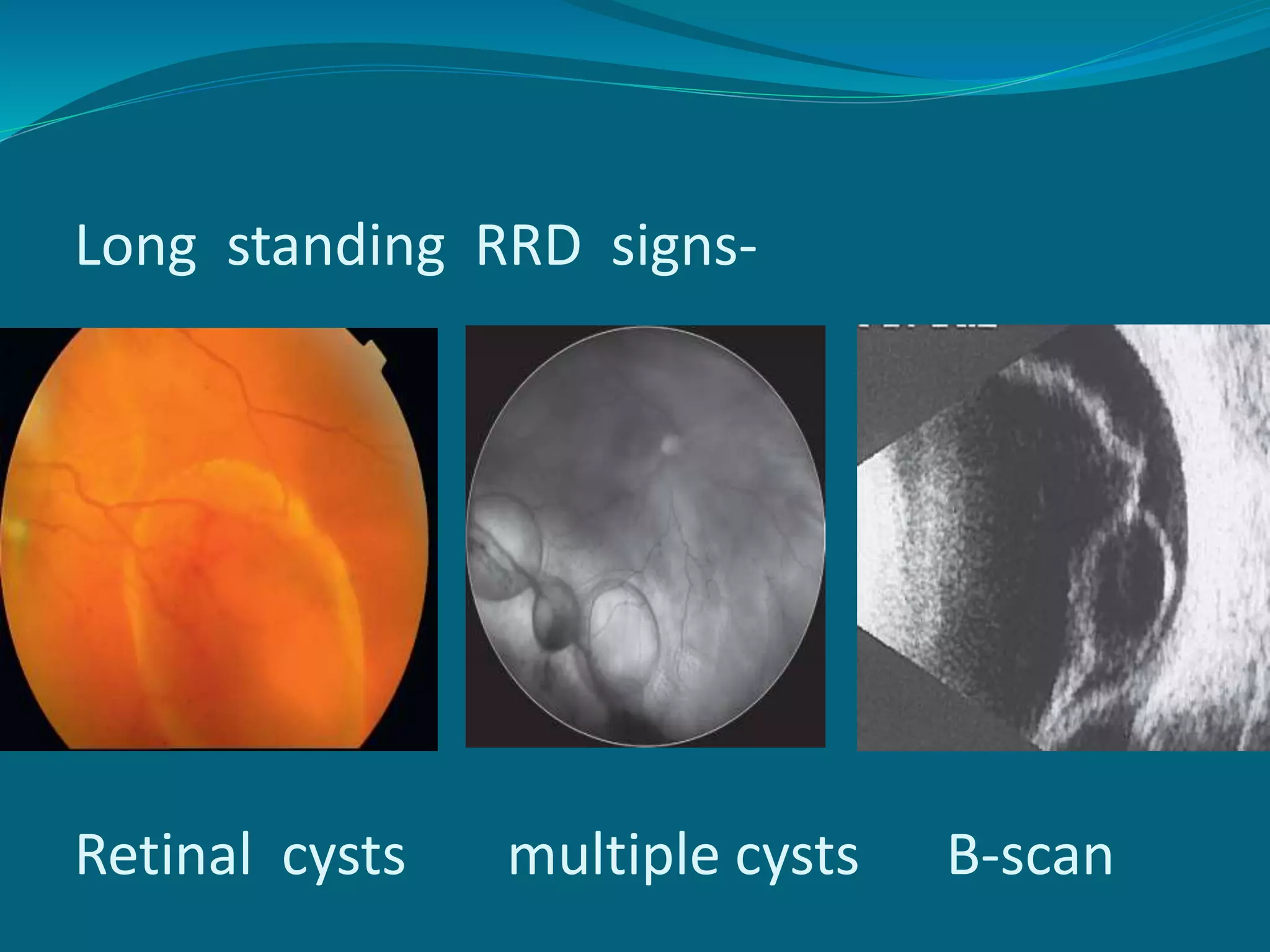 Retinal detachment | PPTX