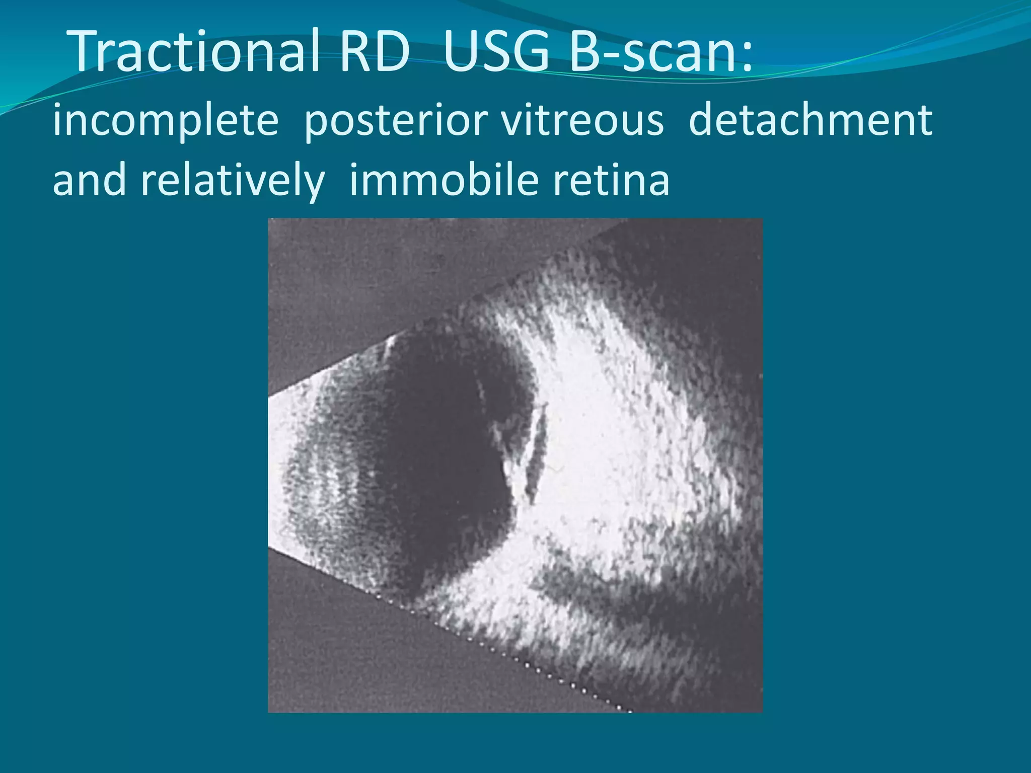 Retinal detachment | PPTX