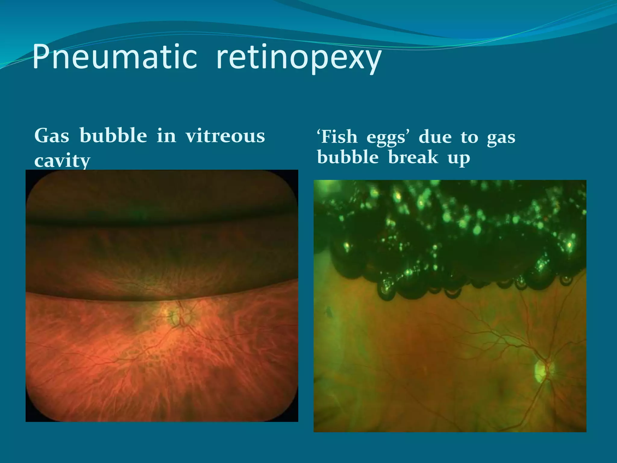 Retinal detachment | PPTX