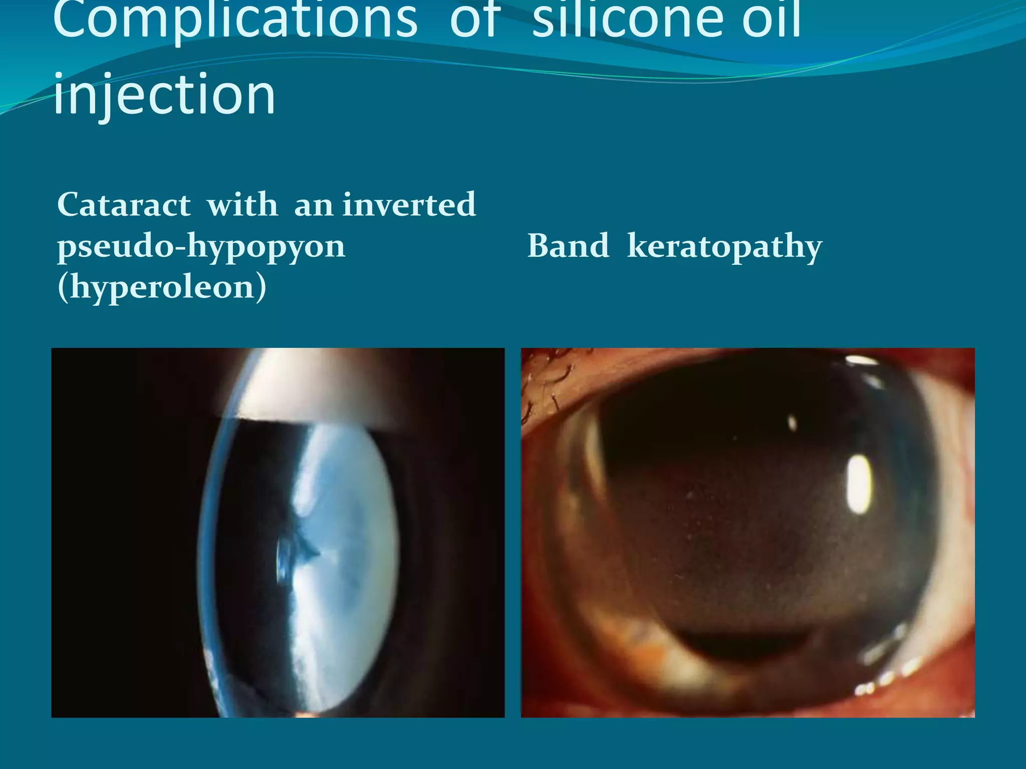Retinal detachment | PPTX