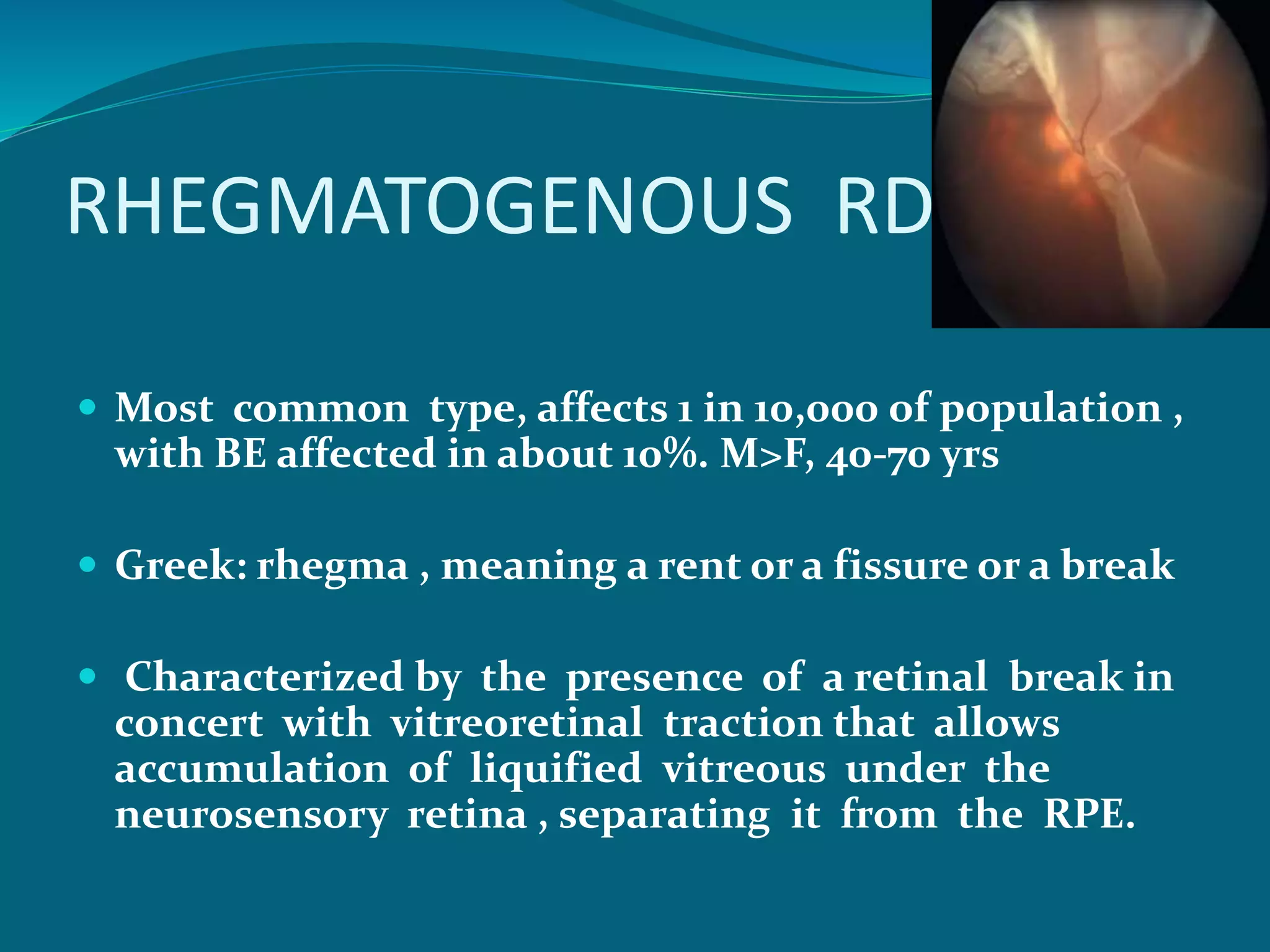 Retinal detachment | PPTX