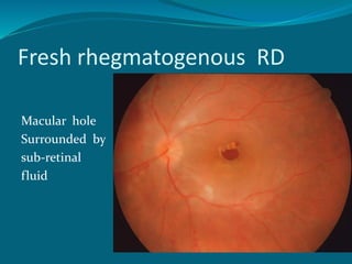 Retinal detachment | PPTX