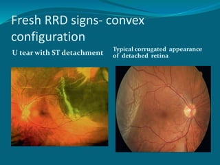 Retinal detachment | PPTX