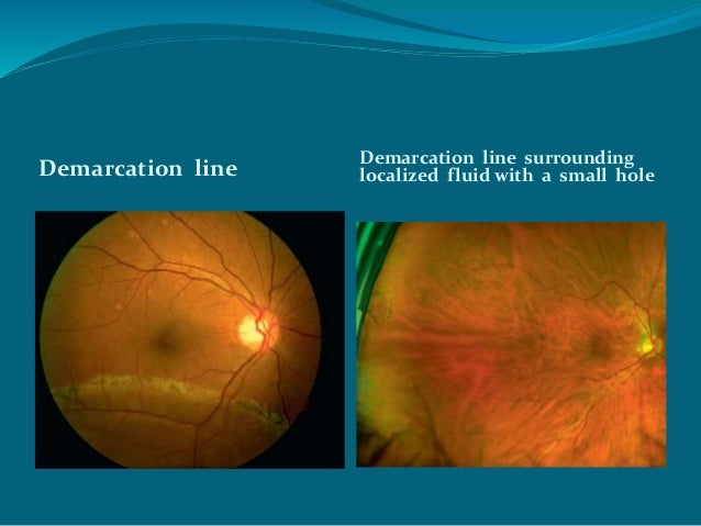 Retinal detachment