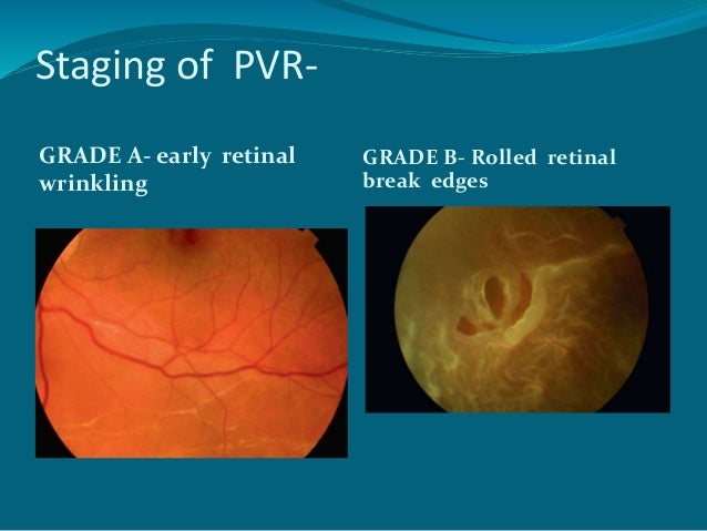 Retinal detachment